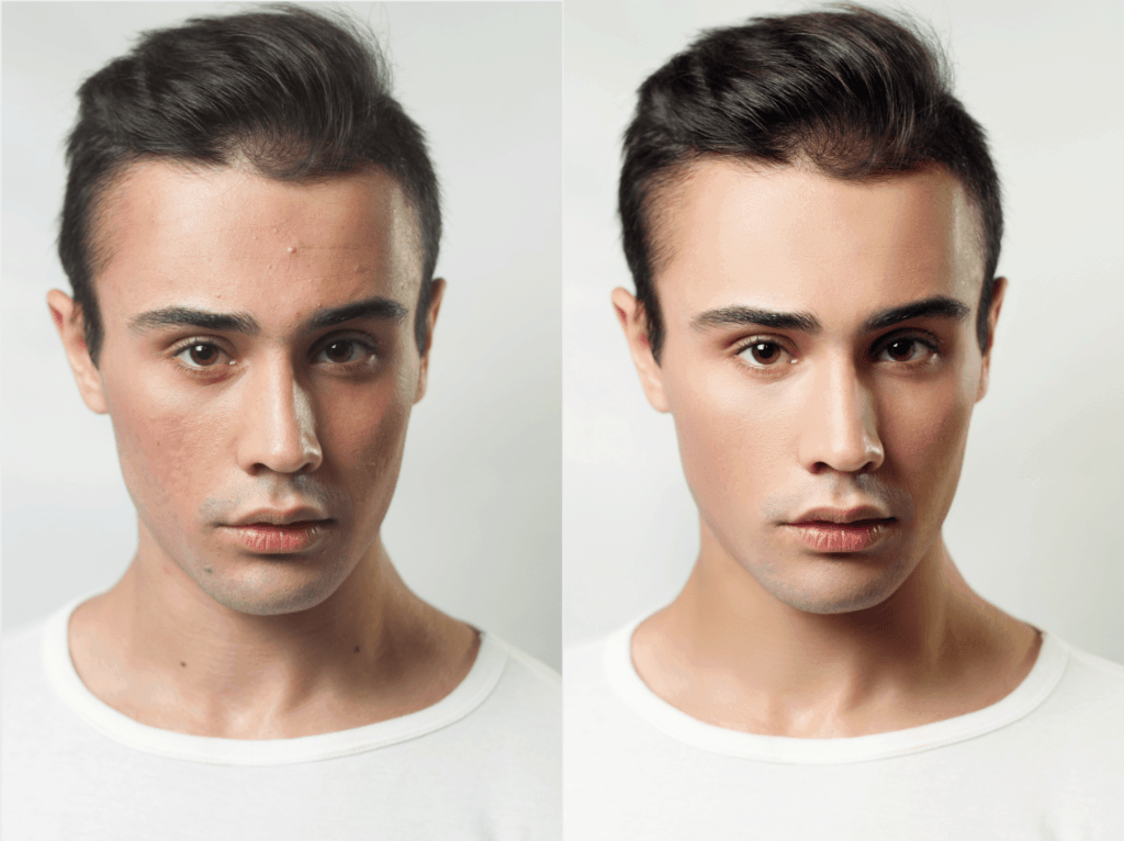 Why It’s Best to Use a Hyfrecator to Remove Cherry Angiomas, Skin Tags ...