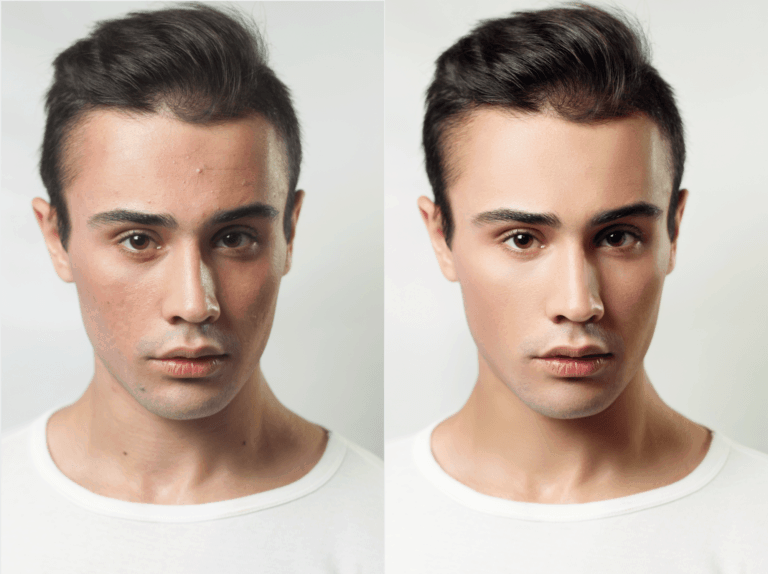 Why It’s Best to Use a Hyfrecator to Remove Cherry Angiomas, Skin Tags ...