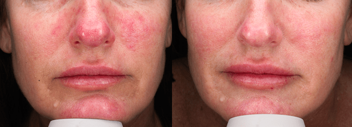How to Manage your Red Face and Facial Flushing - NOVA Plastic Surgery ...