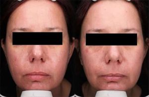 Hyfrecator Treatments | Cautery and Electrocautery Treatments in ...