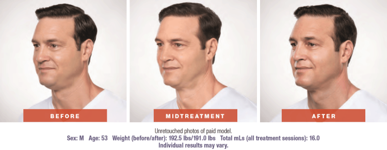 Kybella Injections and Double Chin Fat Reduction Treatments