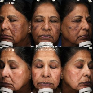 MOXI® Laser Treatment in Ashburn, VA - NOVA Plastic Surgery and Dermatology