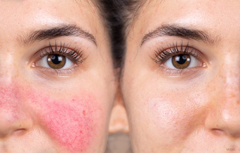 Tired of Being Caught Red-Faced? 3 Ways to Treat Facial Redness - NOVA ...